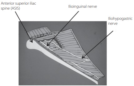 Abdominal wall blocks - PedsAnesthesiaNet