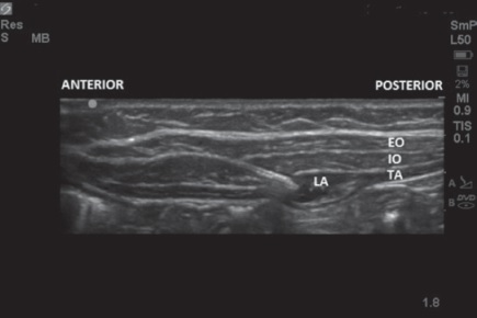 Abdominal wall blocks - PedsAnesthesiaNet
