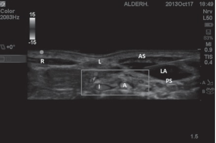Abdominal wall blocks - PedsAnesthesiaNet